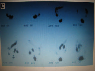 Nuclear Medicine - Another Way Of Learning: SMALL AND LARGE BOWEL ...